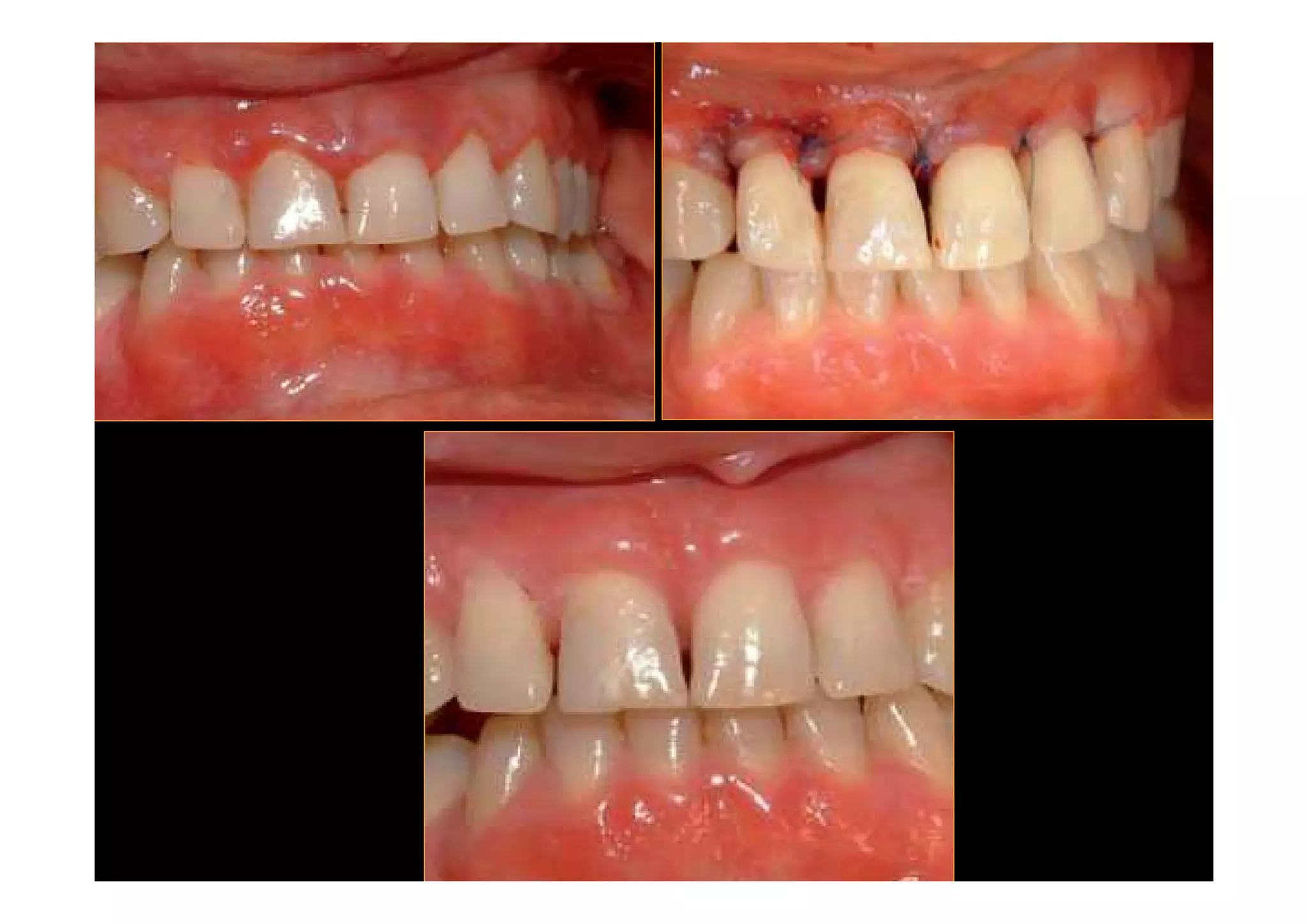 Modified widman flap | PDF