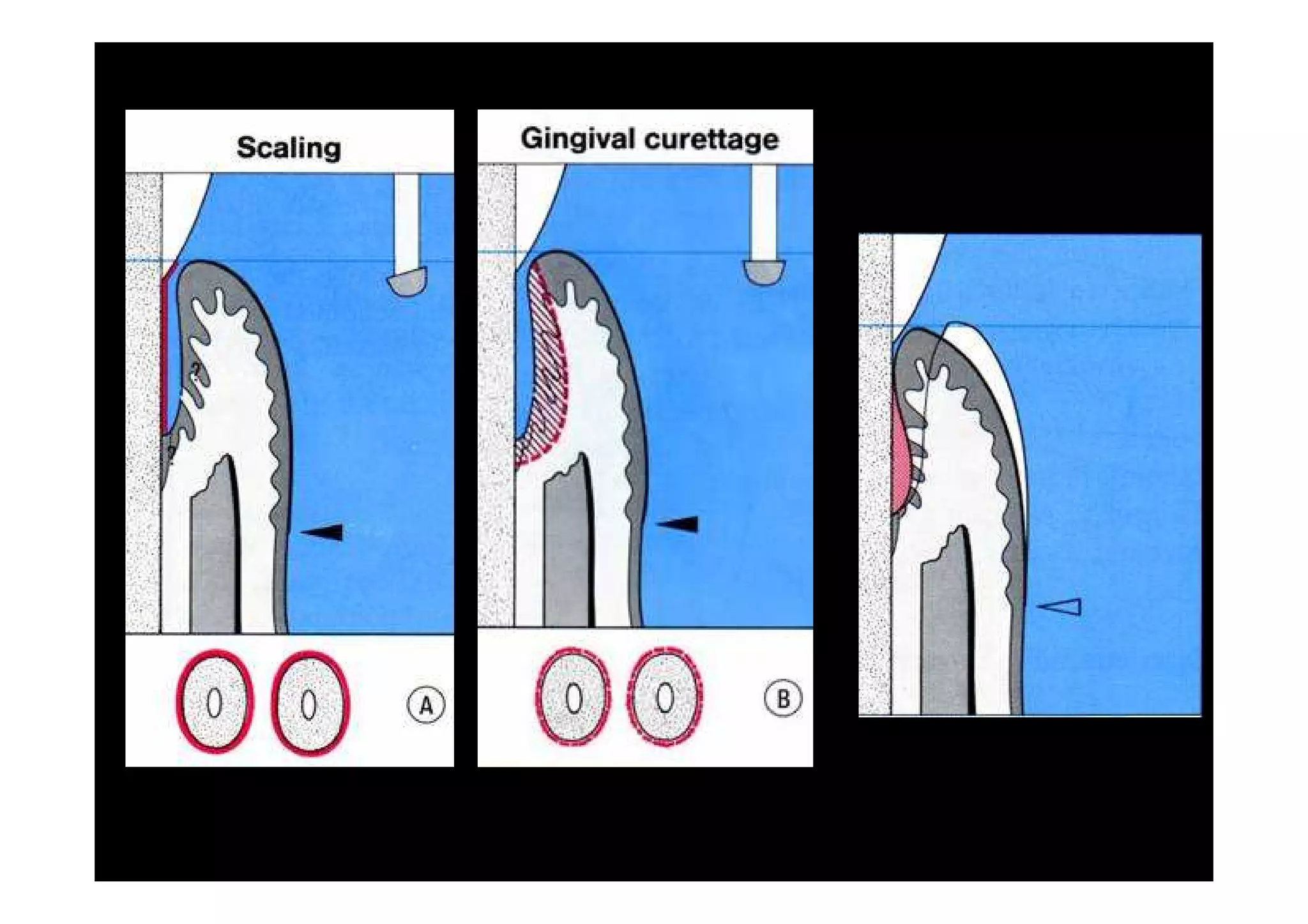 Modified widman flap | PDF