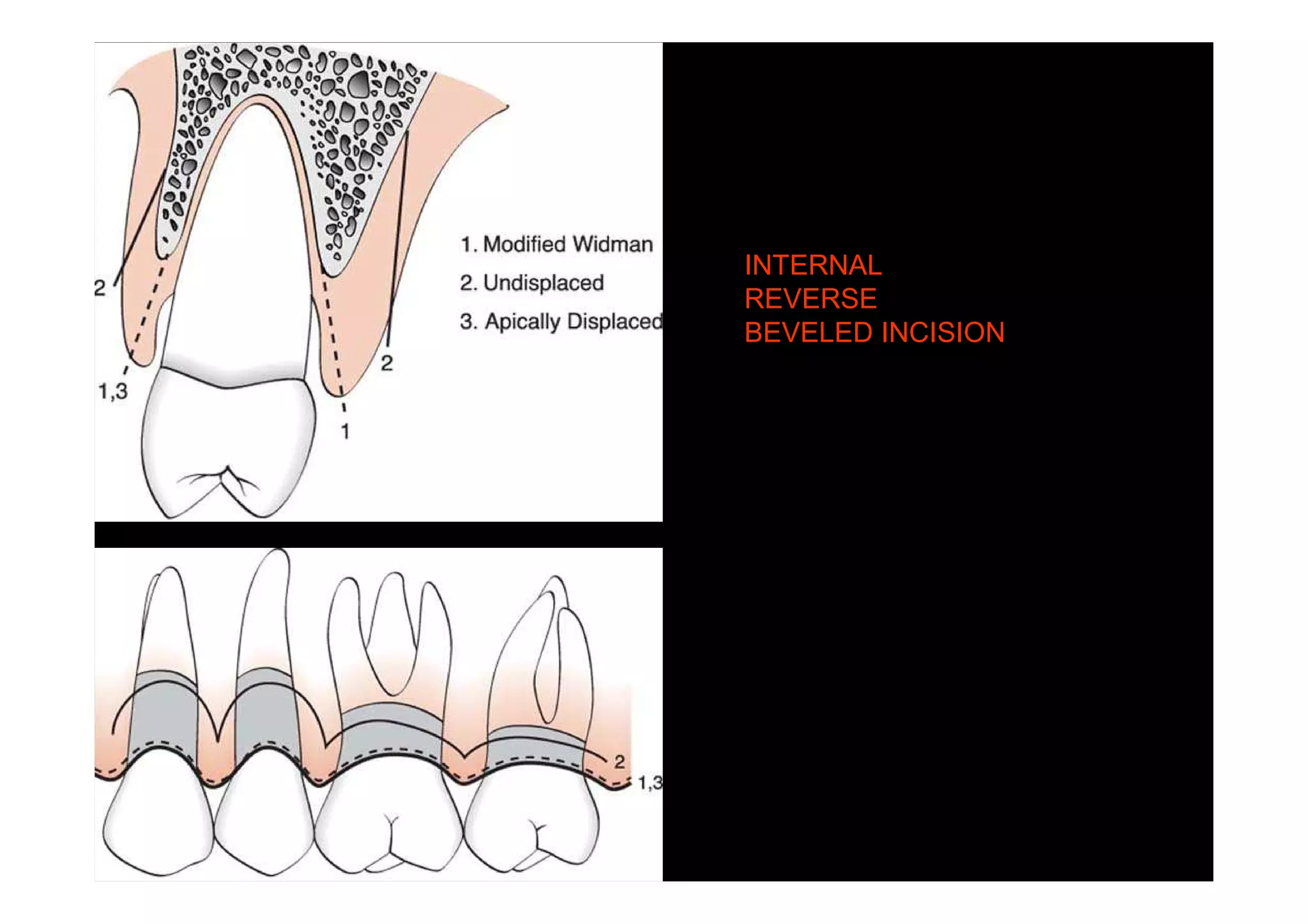 Modified widman flap | PDF