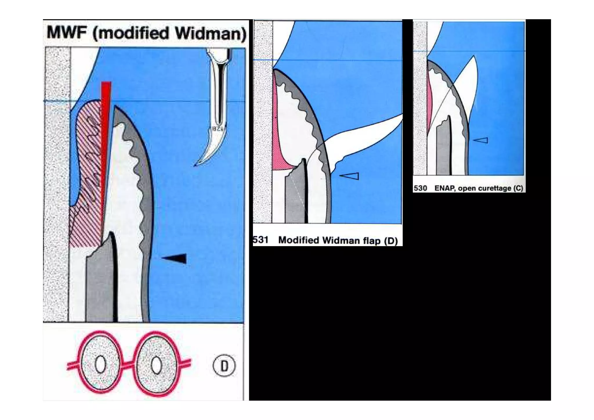 Modified widman flap | PDF