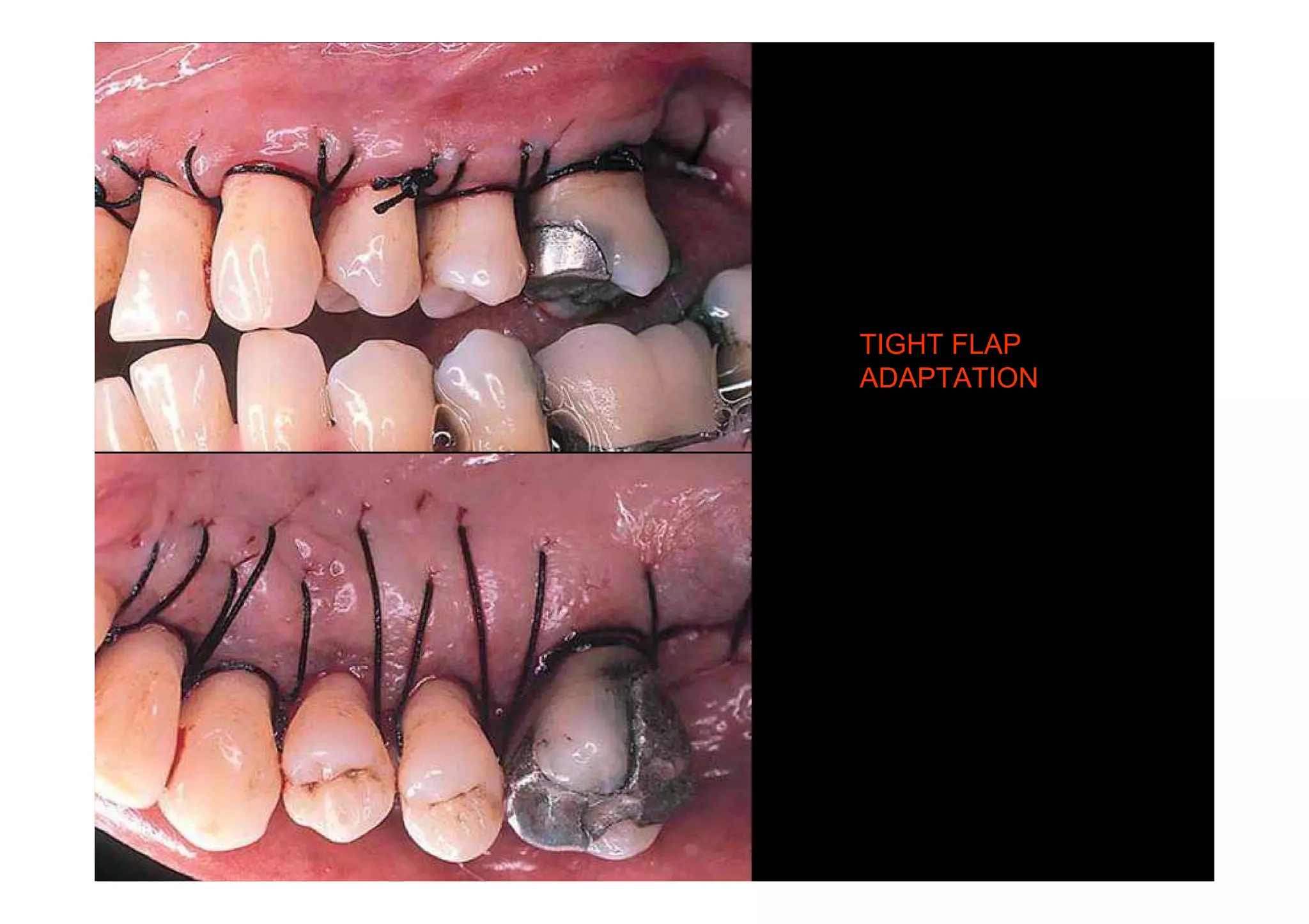 Modified widman flap | PDF