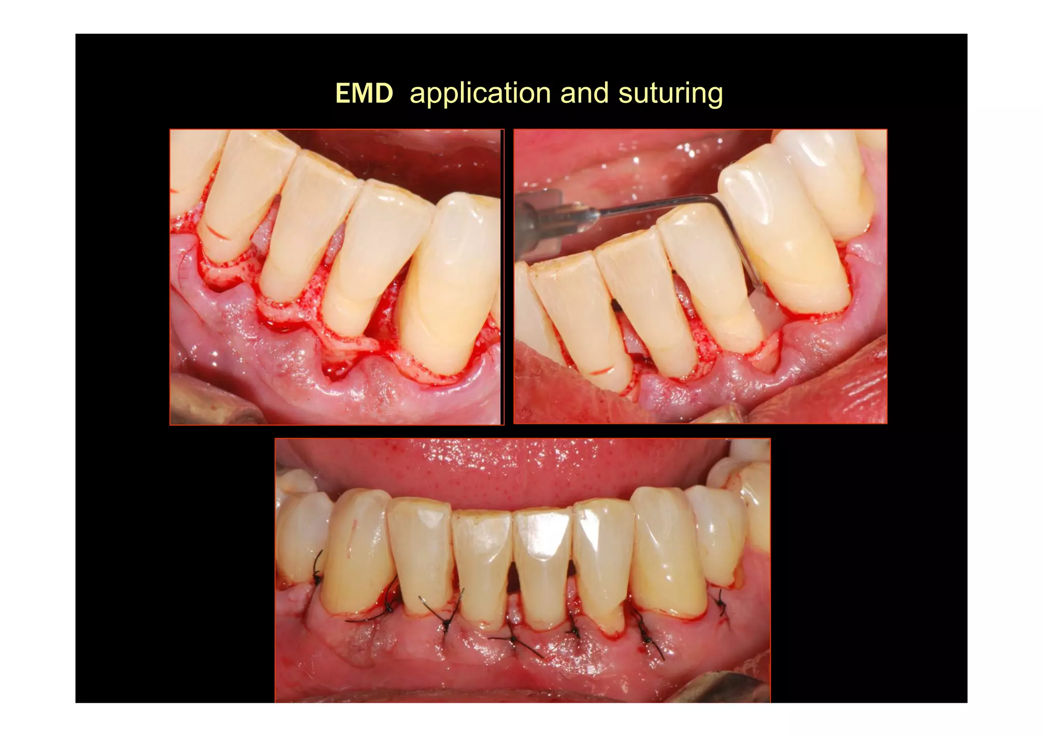 Modified widman flap | PDF