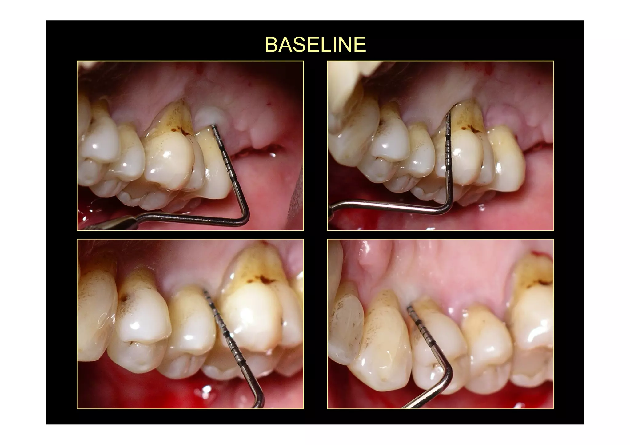 Modified widman flap | PDF