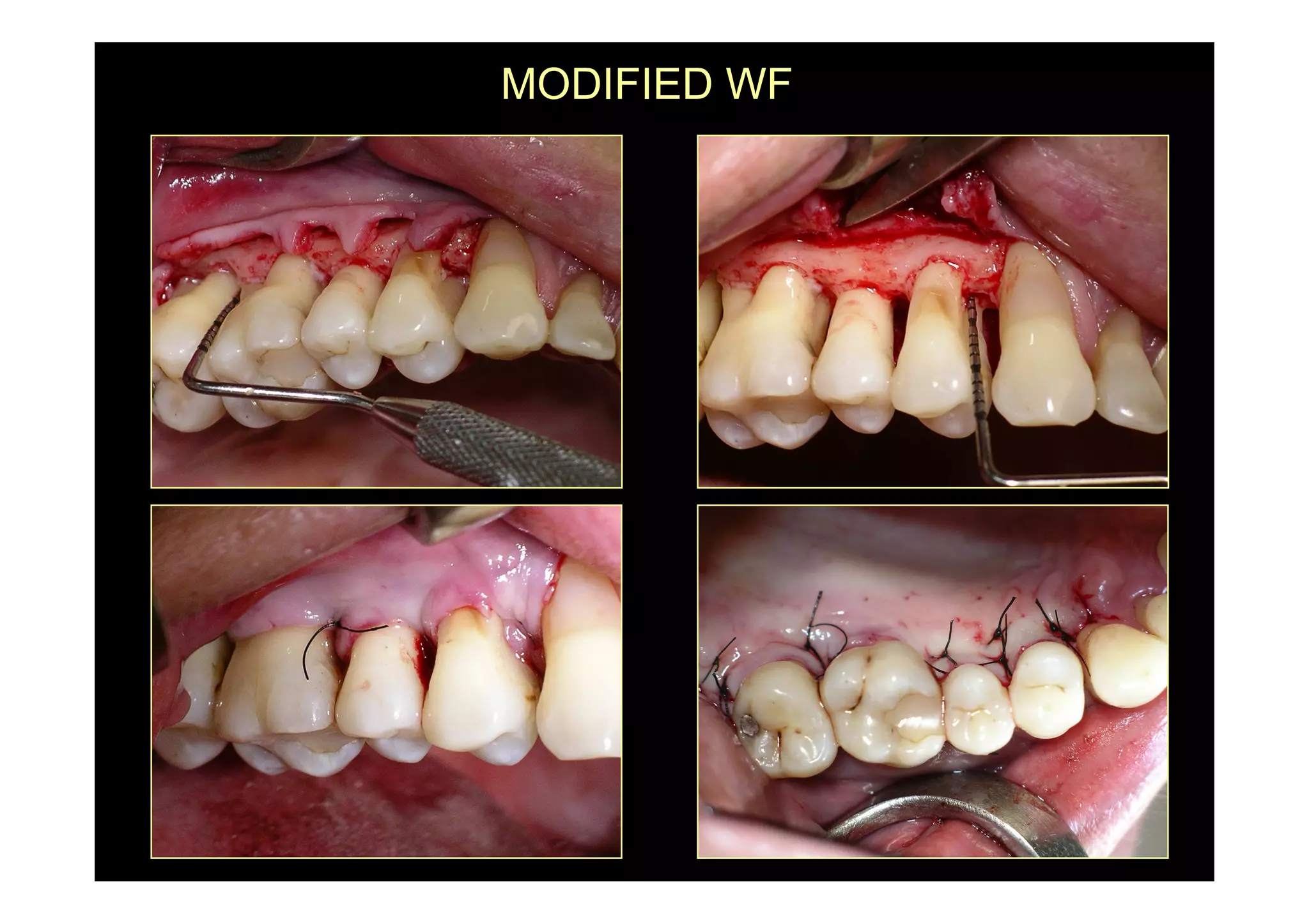 Modified widman flap | PDF