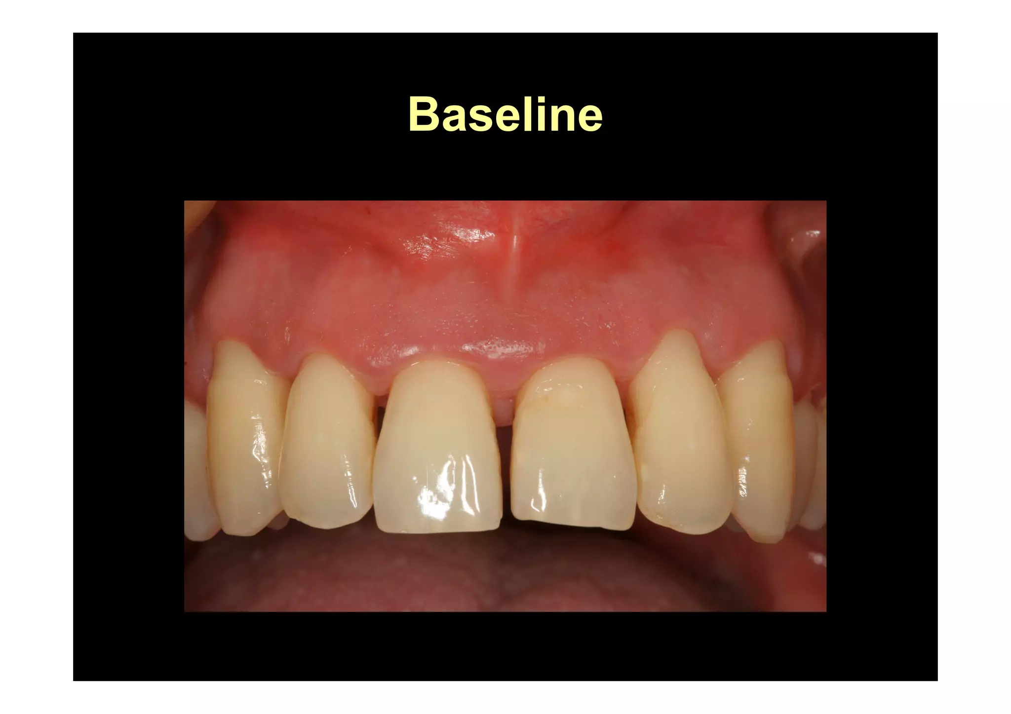 Modified widman flap | PDF
