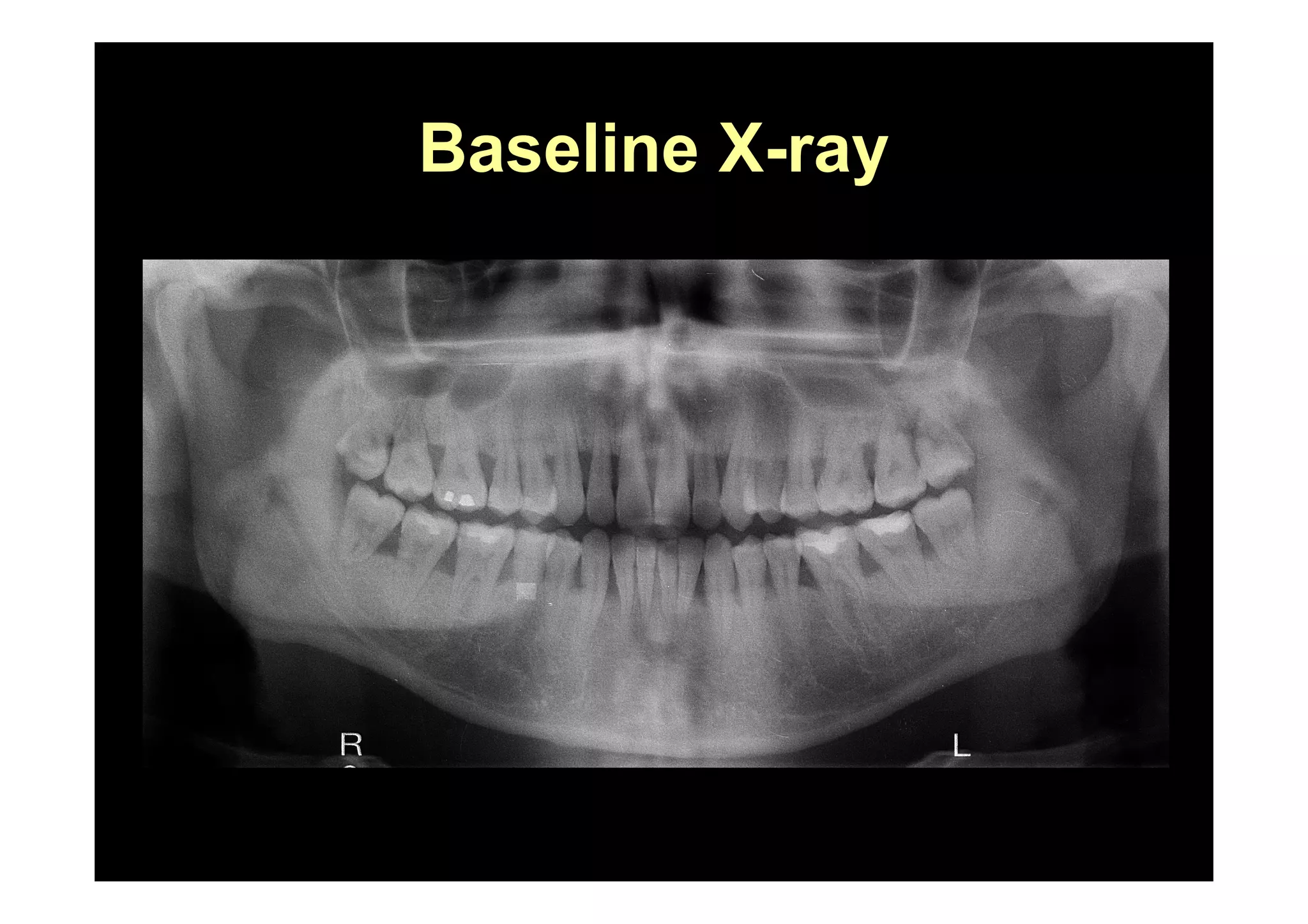Modified widman flap | PDF