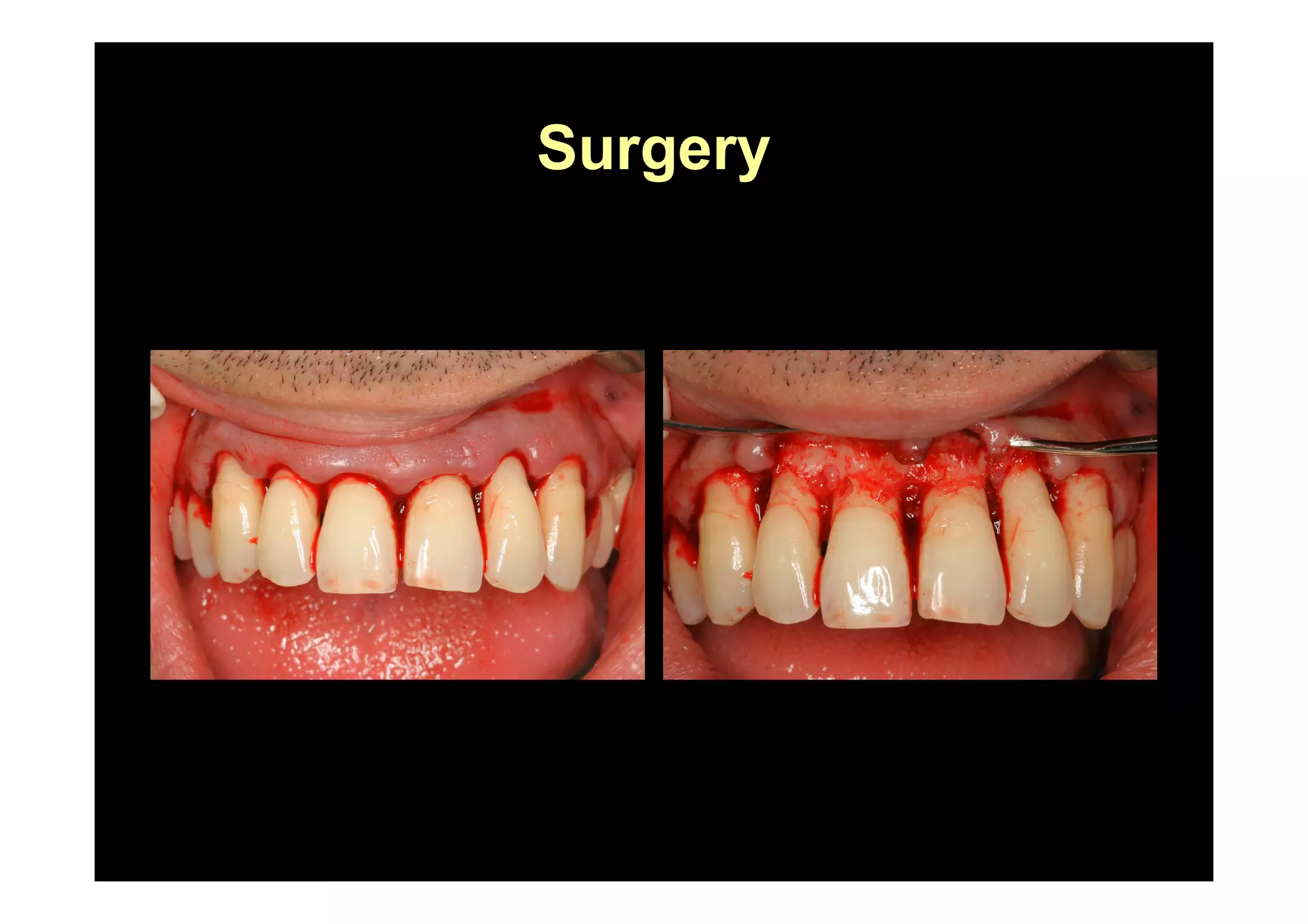 Modified widman flap | PDF