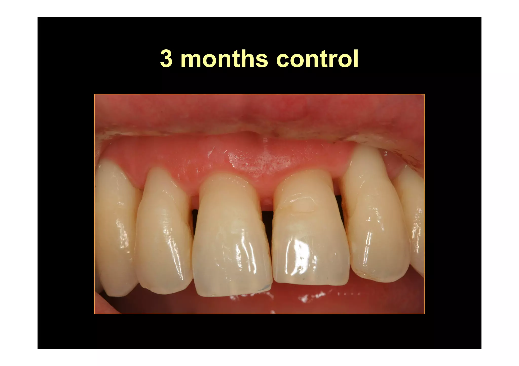 Modified widman flap | PDF