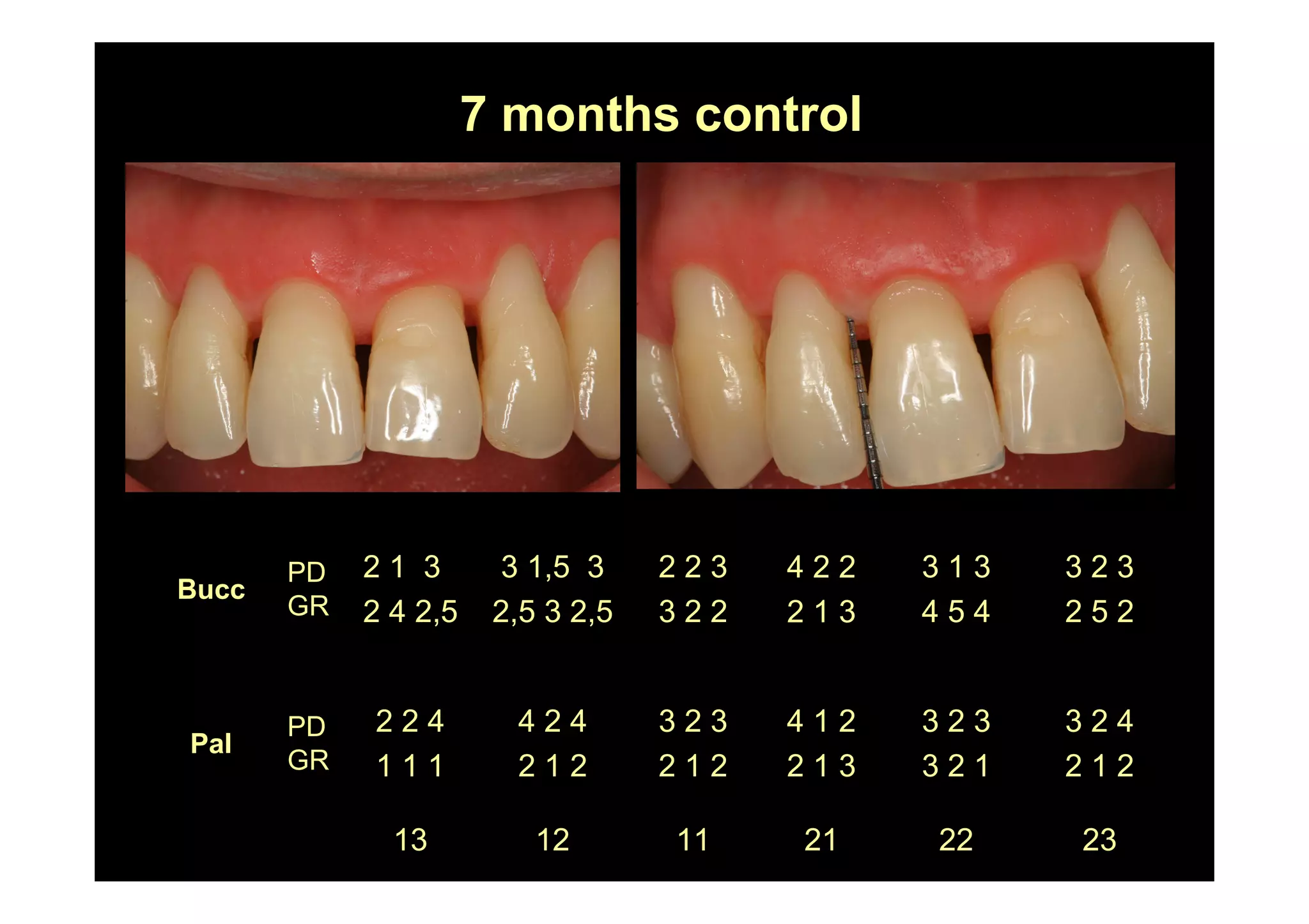 Modified widman flap | PDF