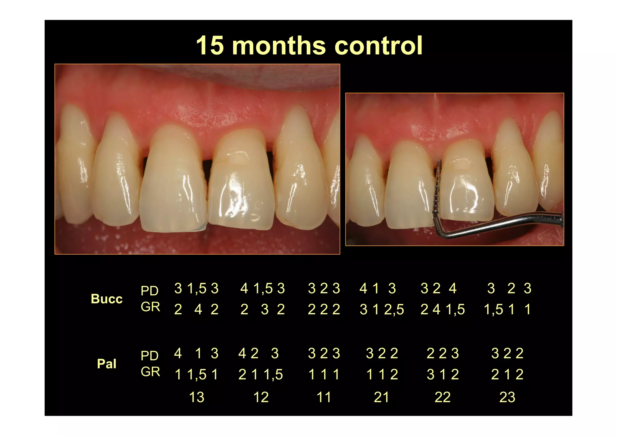 Modified widman flap | PDF