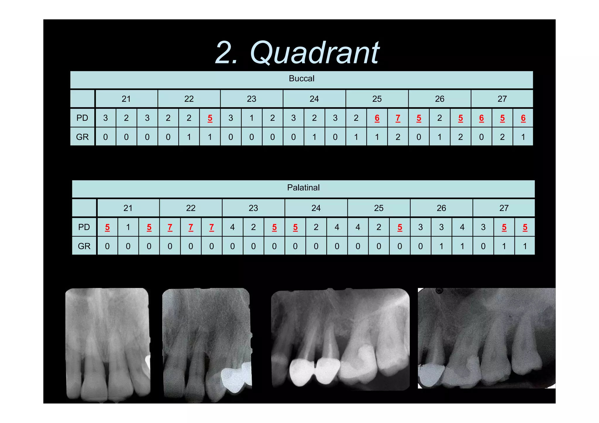 Modified widman flap | PDF