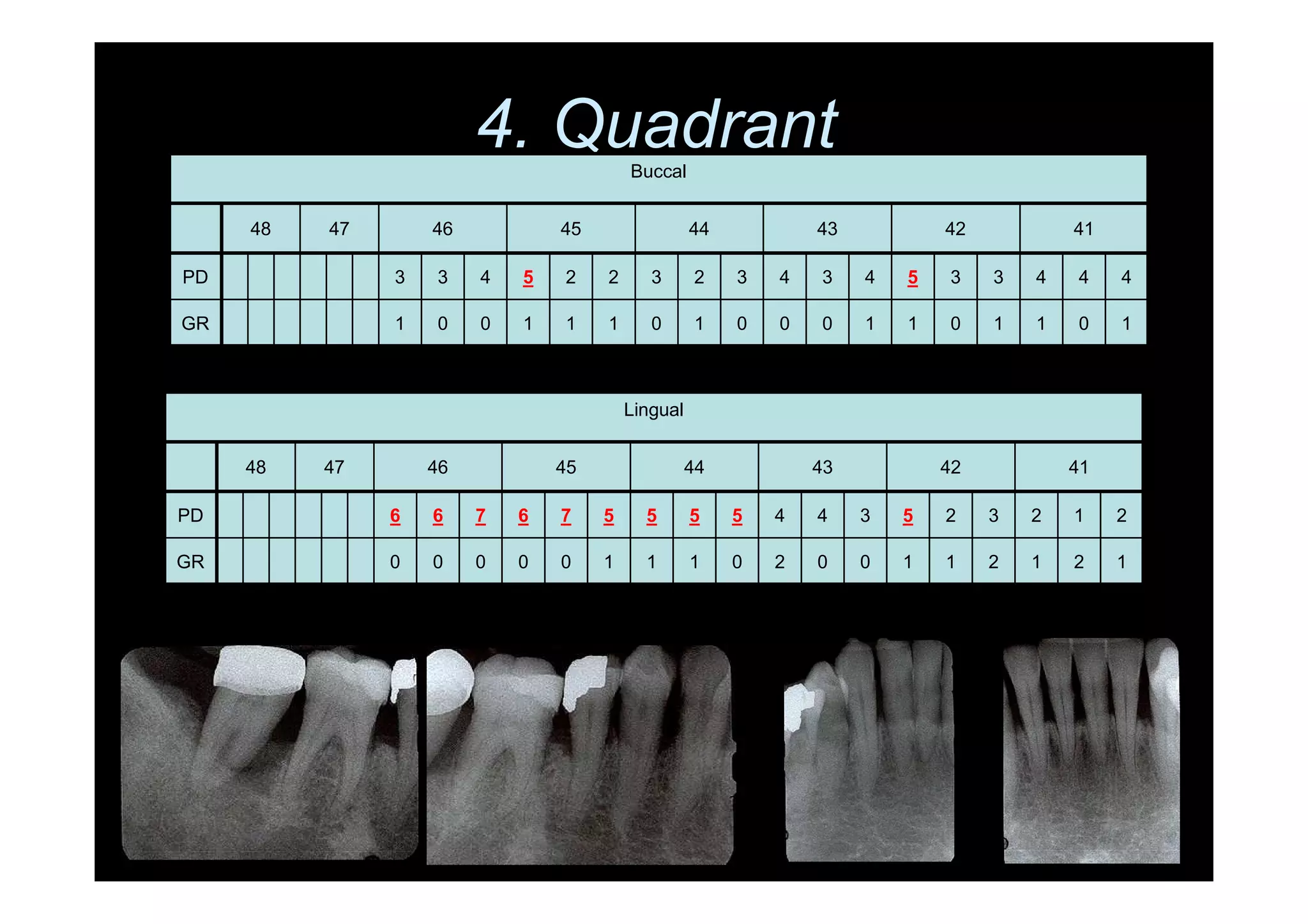 Modified widman flap | PDF