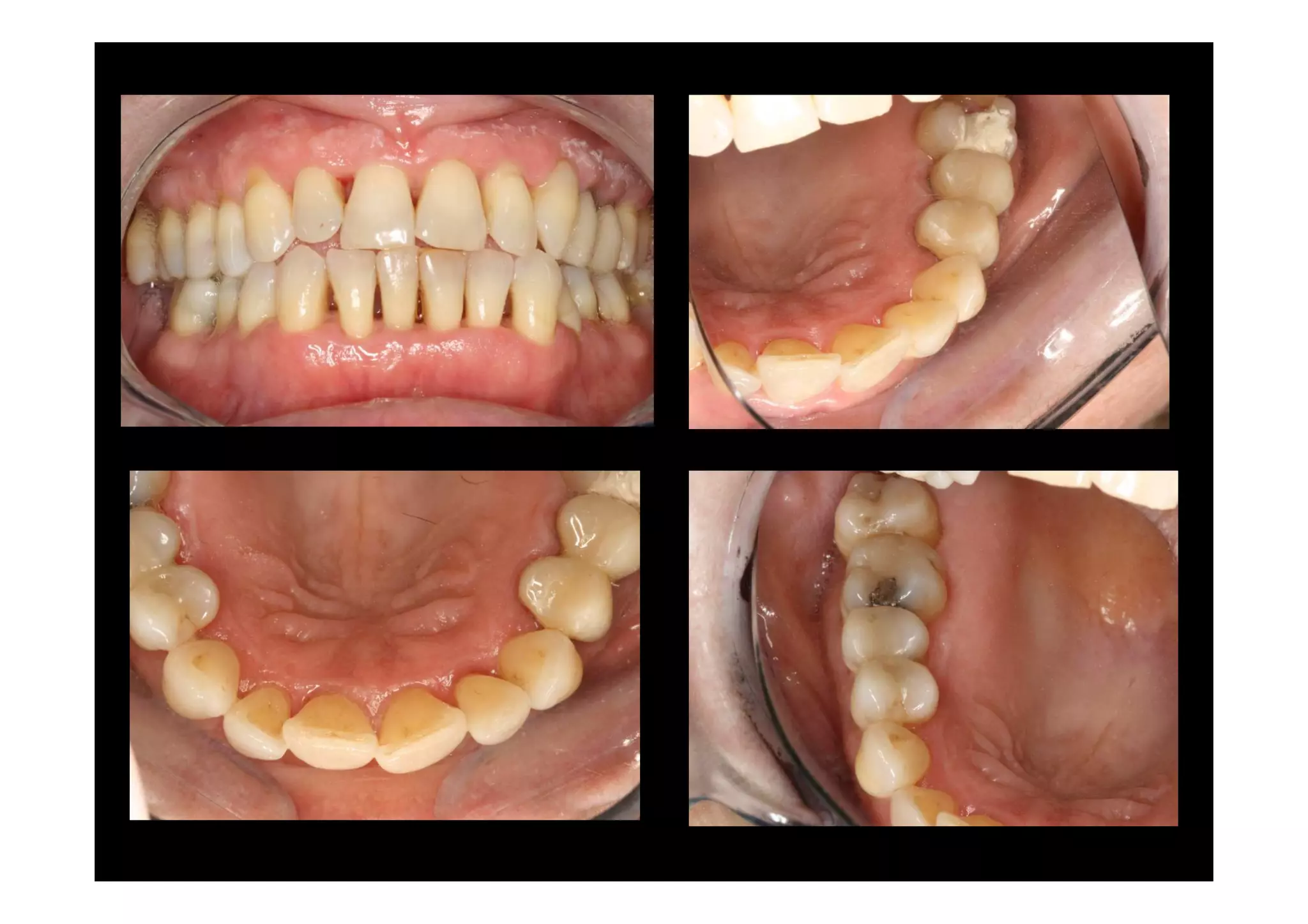 Modified widman flap | PDF