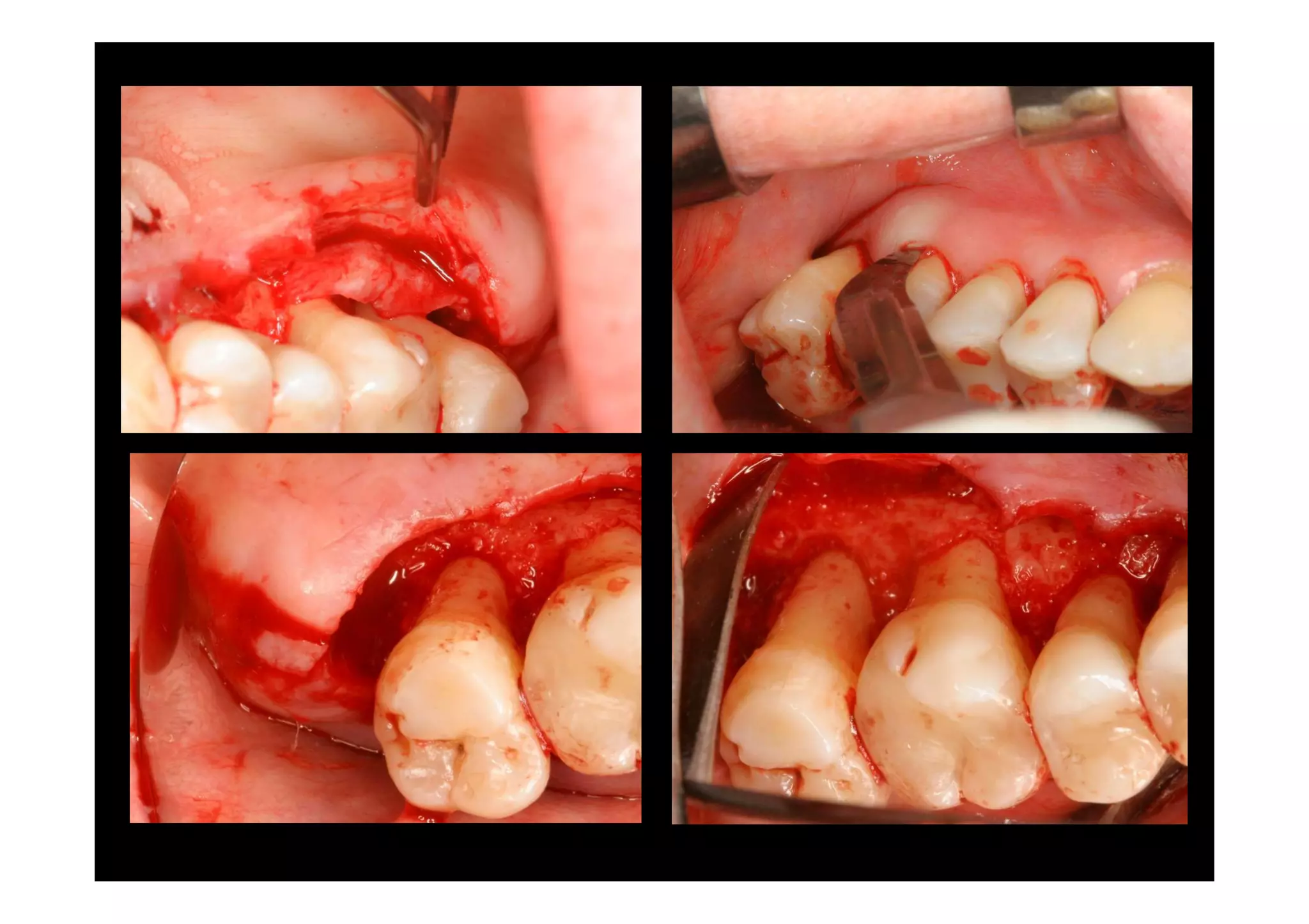 Modified widman flap | PDF