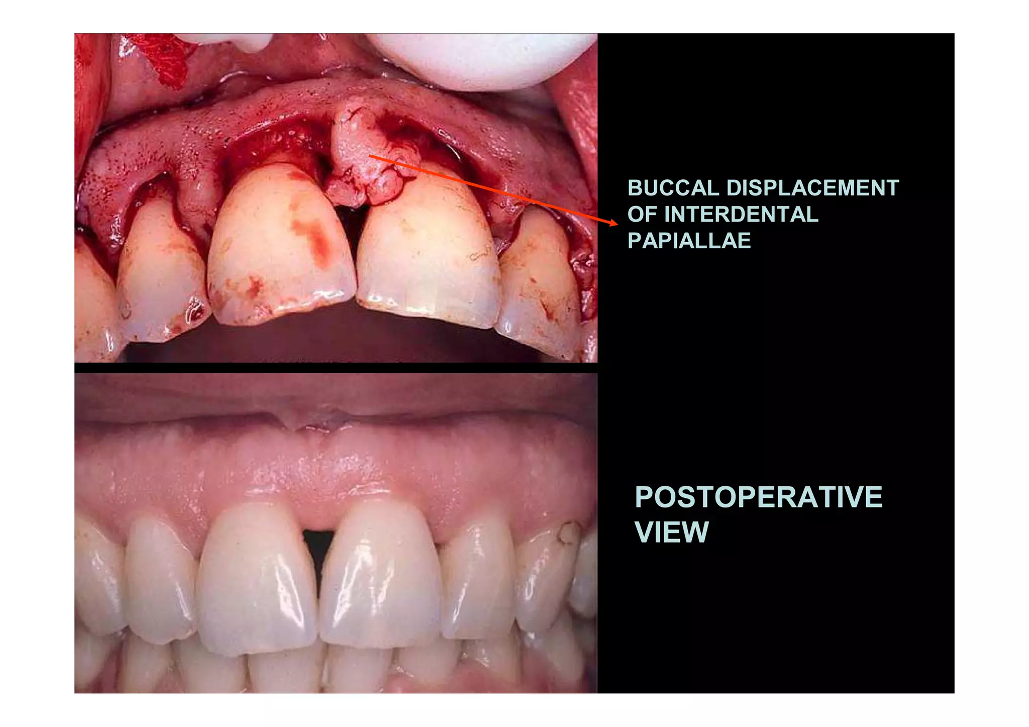 Modified widman flap | PDF