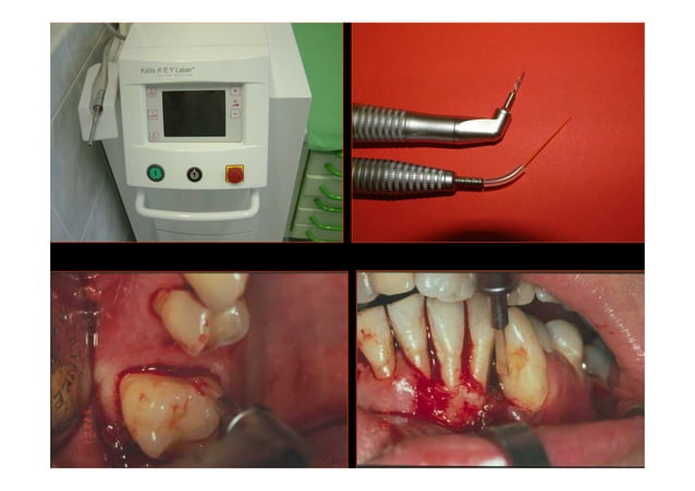 Modified widman flap | PDF