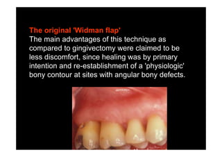 Modified widman flap | PDF
