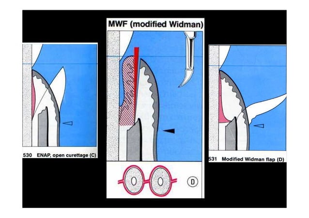 Modified widman flap | PDF