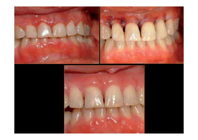 Modified widman flap | PDF