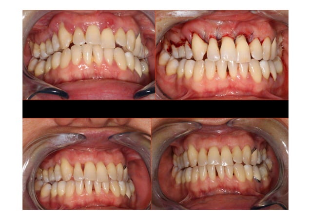 Modified widman flap | PDF