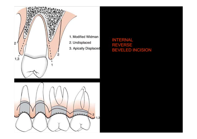 Modified widman flap | PDF