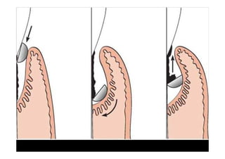 Modified widman flap | PDF