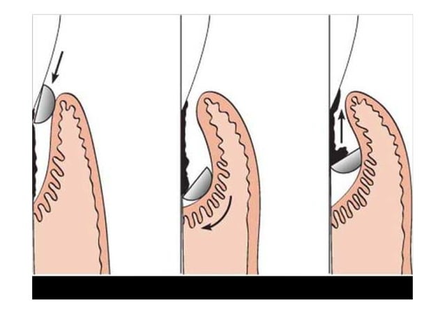 Modified widman flap | PDF