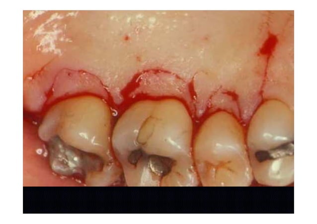 Modified widman flap | PDF