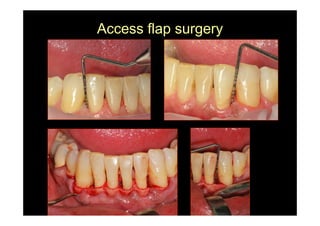 Modified widman flap | PDF