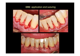 Modified widman flap | PDF