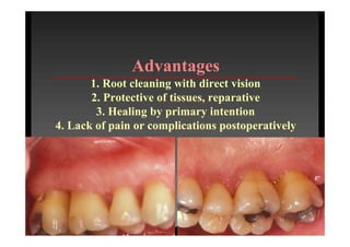 Modified widman flap | PDF