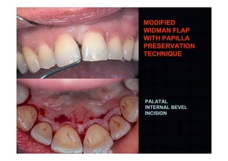 Modified widman flap | PDF