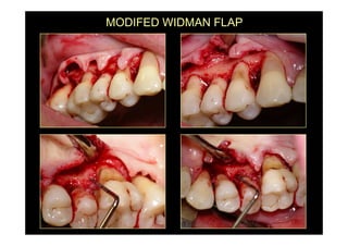 Modified widman flap | PDF