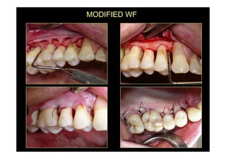 Modified widman flap | PDF