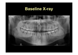 Modified widman flap | PDF