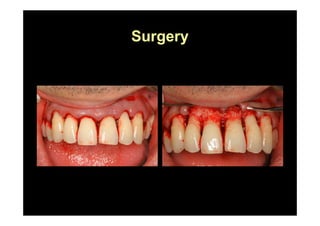 Modified widman flap | PDF
