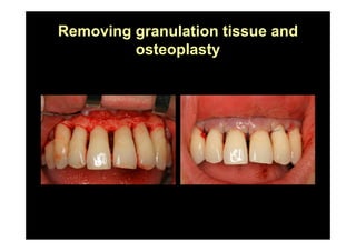 Modified widman flap | PDF