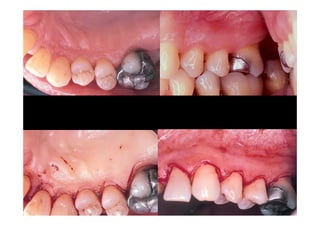 Modified widman flap | PDF