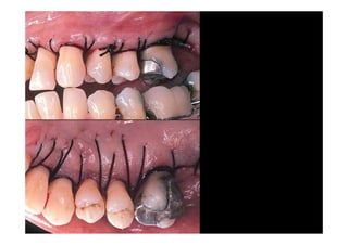 Modified widman flap | PDF