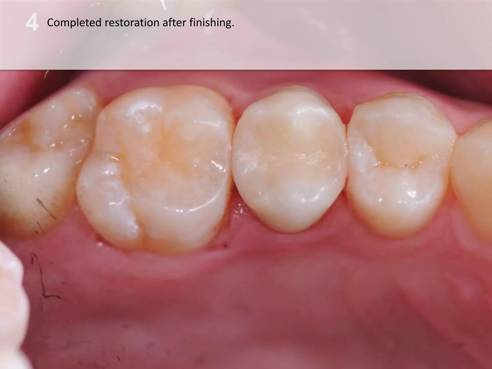 Mod on Second Premolar using V3 Universal and Narrow rings by David ...