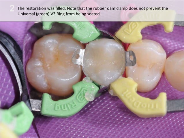 Mod on Second Premolar using V3 Universal and Narrow rings by David ...