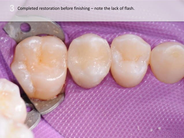 Mod on Second Premolar using V3 Universal and Narrow rings by David ...
