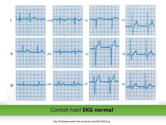 Modul 1 kb2 perekaman elektro kardiografi
