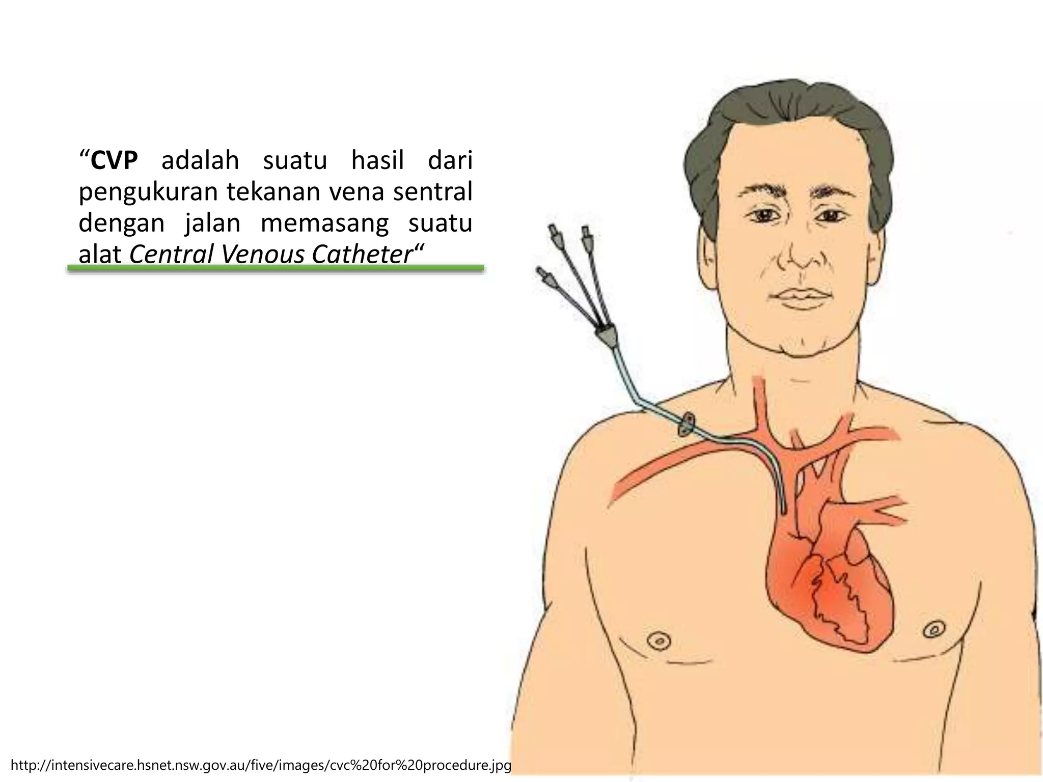 Modul 1 kb3 pengukuran central venous pressure (cvp) | PPTX
