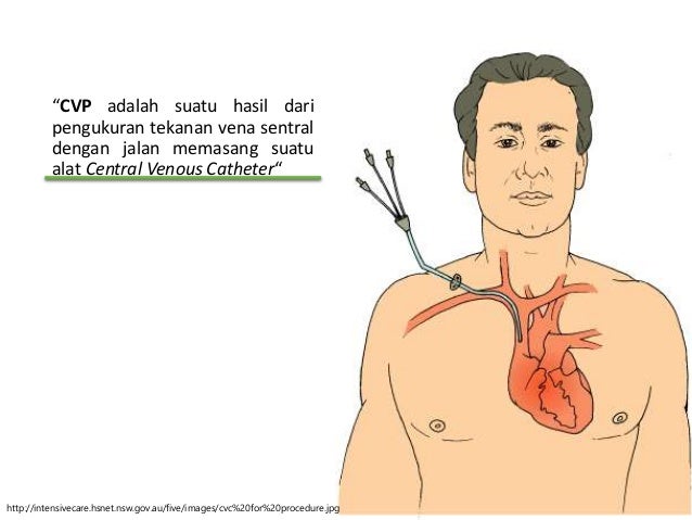 Modul 1 kb3 pengukuran central venous pressure (cvp)