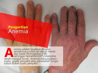 Asuhan Keperawatan Pada Pasien Dengan Anemia | PPTX