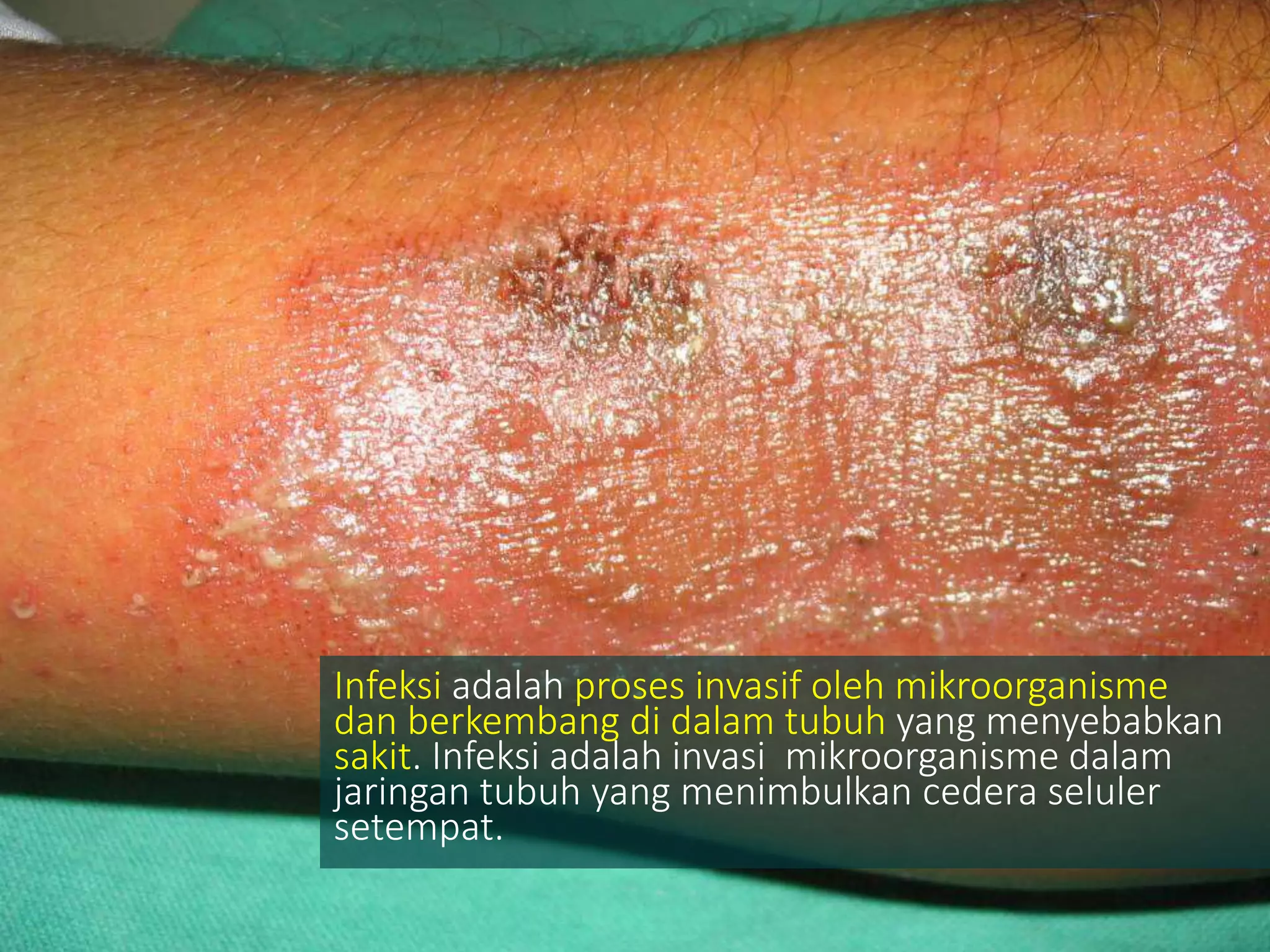 Radang dan mekanisme proses Infeksi | PPTX