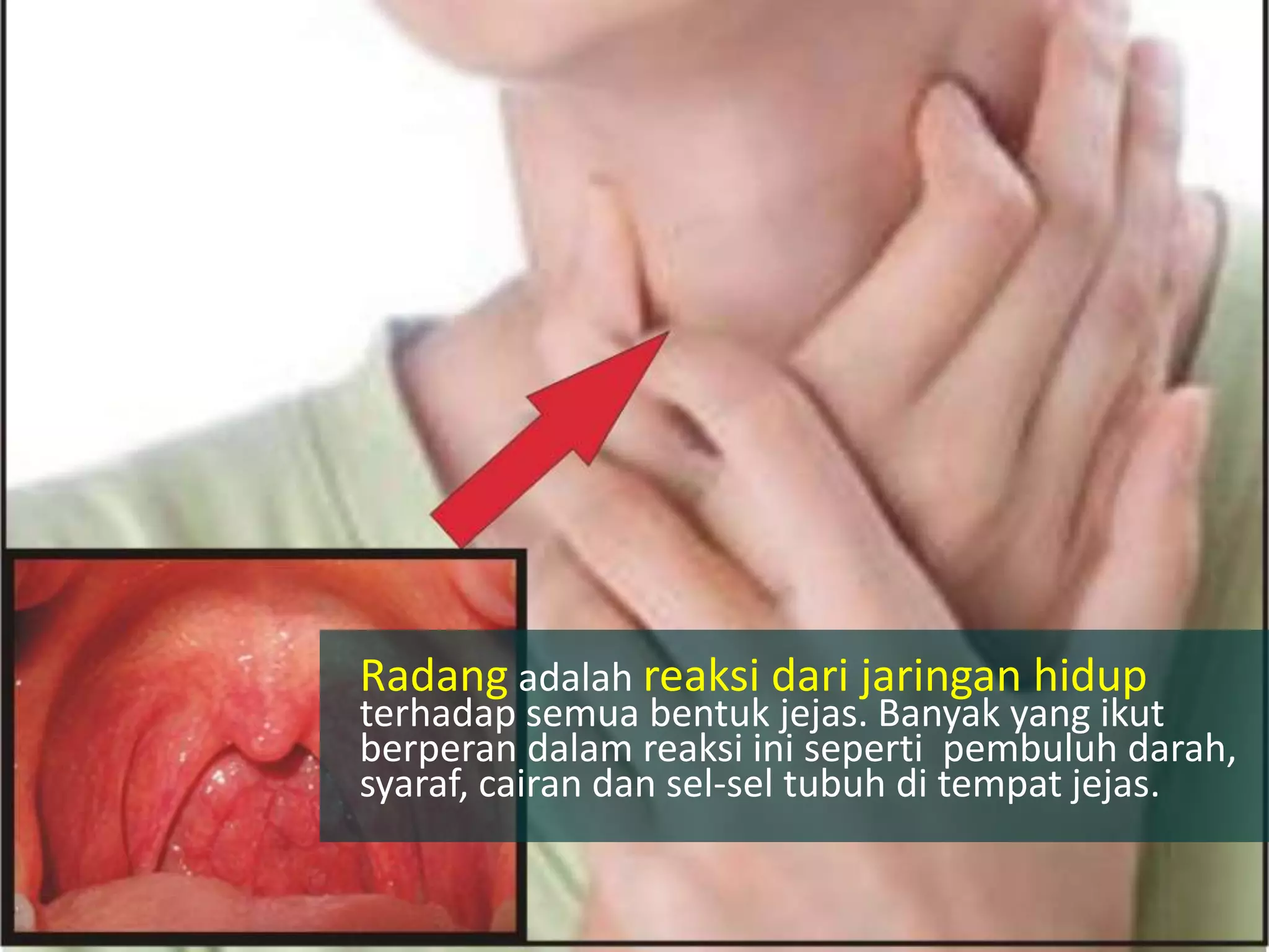 Radang dan mekanisme proses Infeksi | PPTX