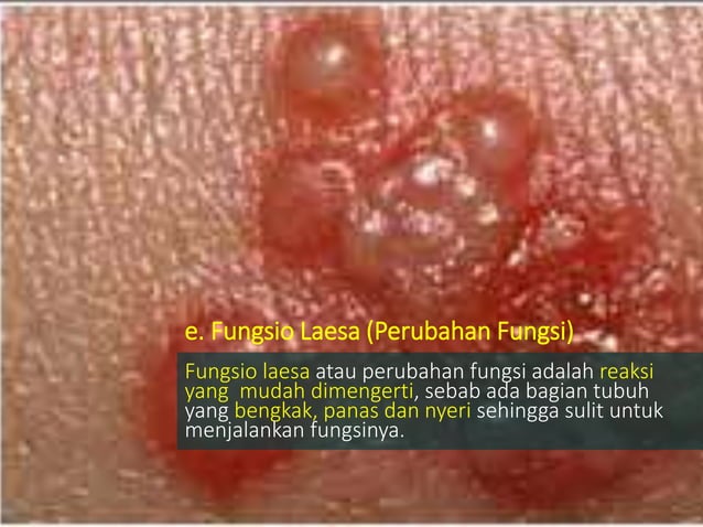 Radang dan mekanisme proses Infeksi | PPTX