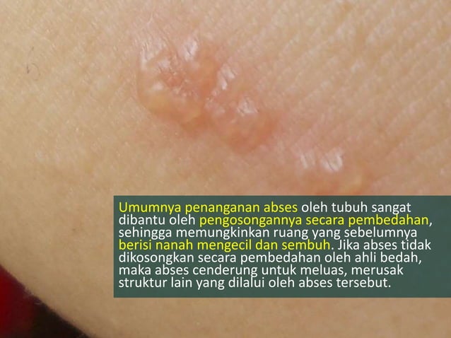 Radang dan mekanisme proses Infeksi | PPTX